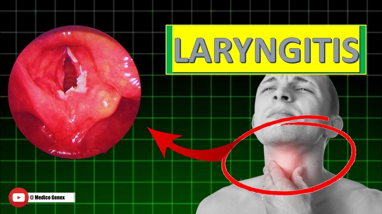 LARYNGITIS EXPERT Reveals Shocking Truth About Chronic Hoarseness - YouTube