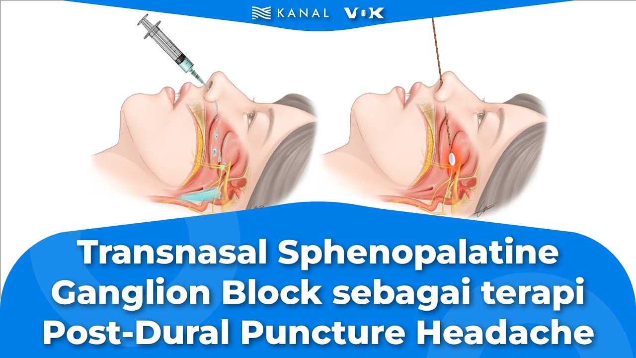 vok-transnasal-sphenopalatine-ganglion-block-sebagai-terapi-post