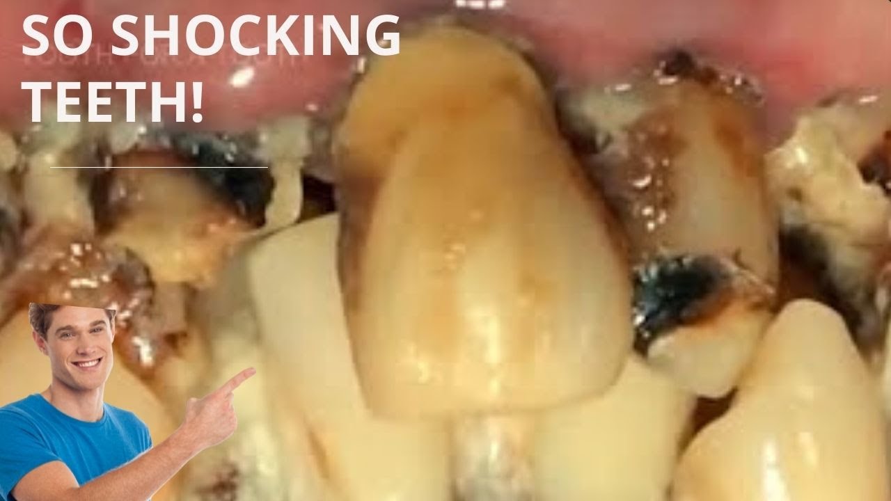 So shocking teeth! - YouTube