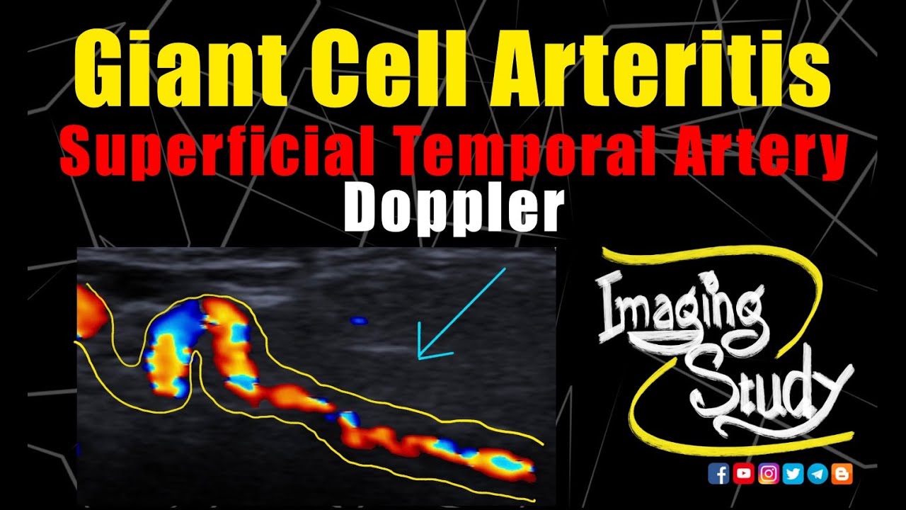 Temporal Arteries Ultrasound Vrogue co temporal-arteries-ultrasound-vrogue-co