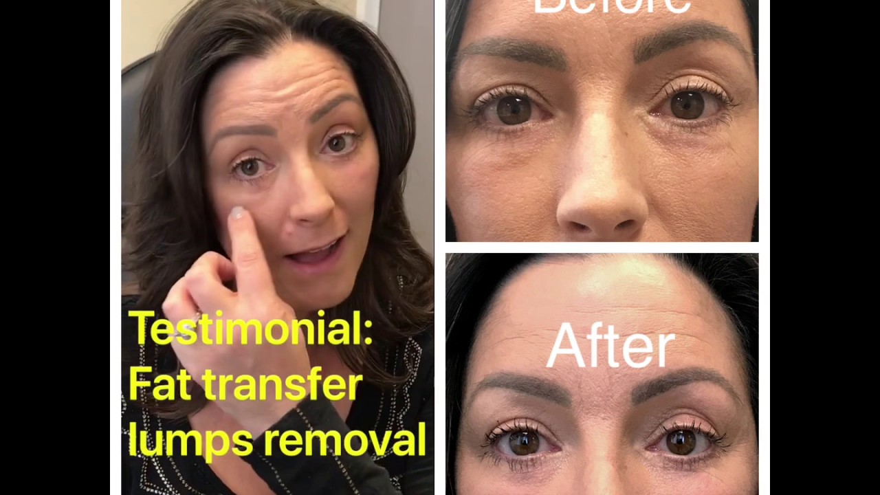 Fat Transfer Lips Lumps | Lipstutorial.org