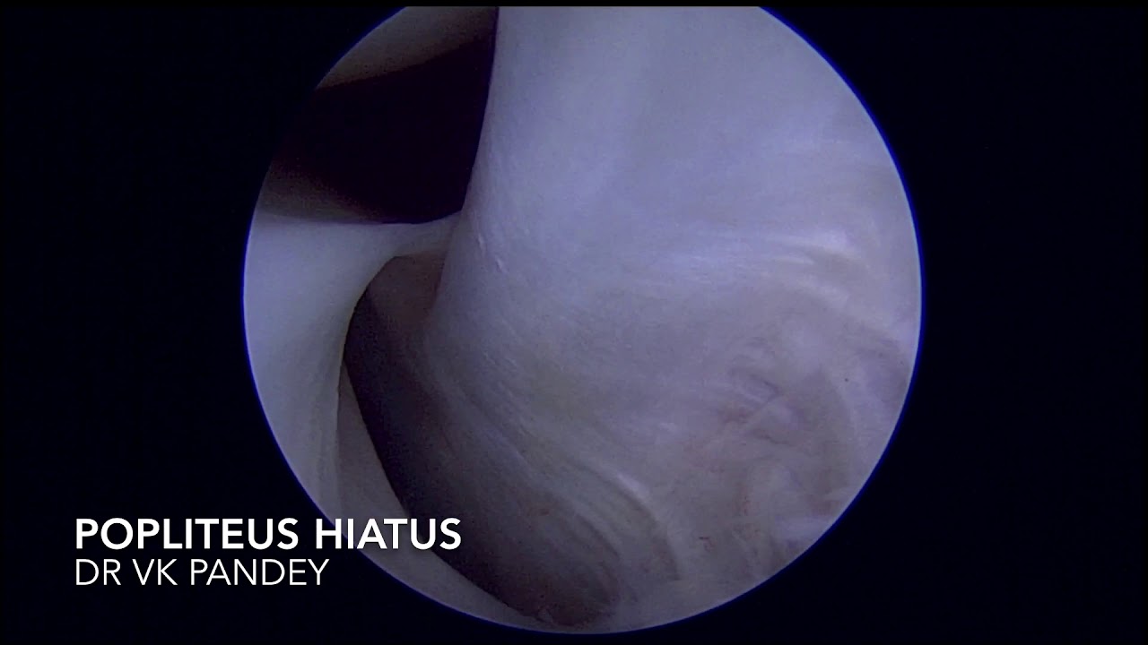 Arthroscopic Anatomy: Popliteus hiatus - YouTube