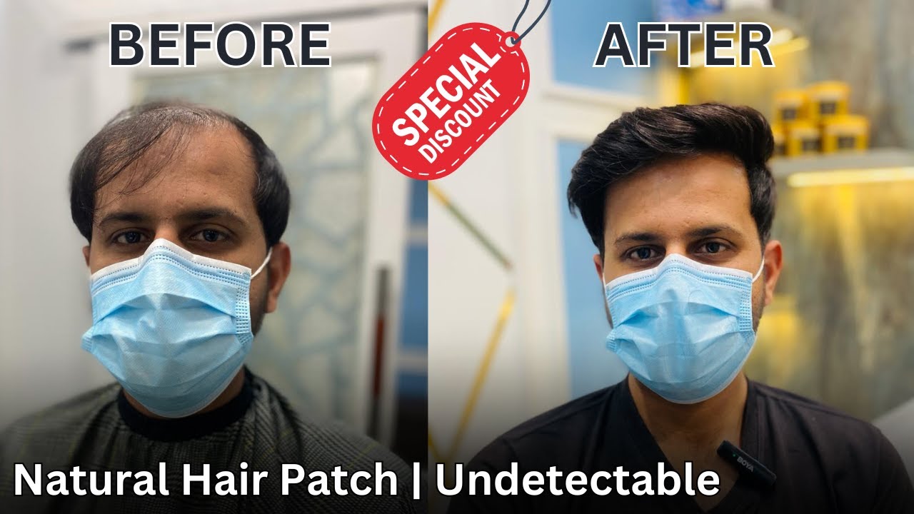 Natural Hair Patch 🔥 | Undetectable 😱 - YouTube