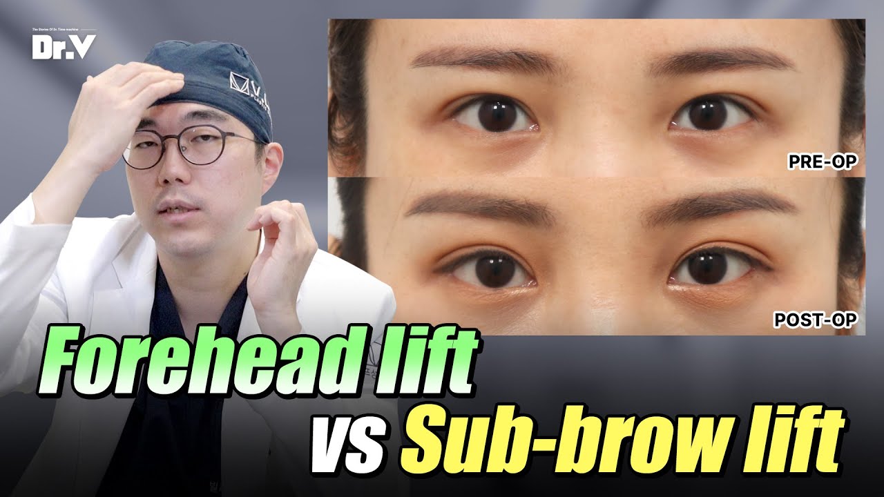 Endoscopic Forehead Lift Youtube at Anthony Griggs blog