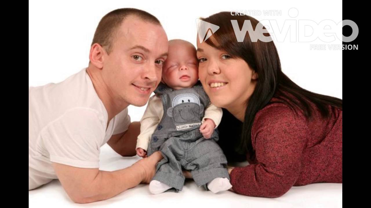 Leri-Weill Dyschondrosteosis (chromosome Y) - YouTube