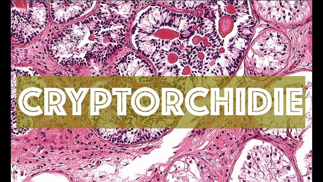LA CRYPTORCHIDIE - PATHOLOGIE - YouTube