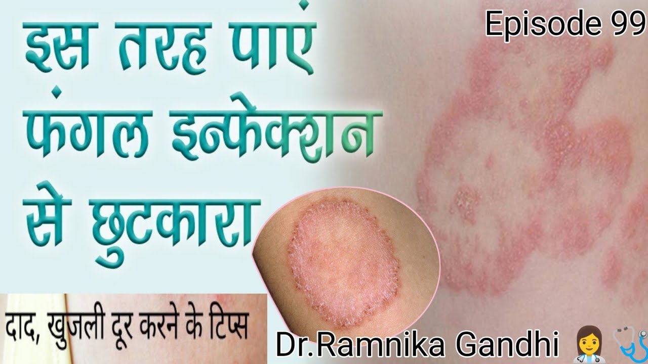 Home remedies for Ring worms /homeopathic medicine Dr.ramnika gandhi ...