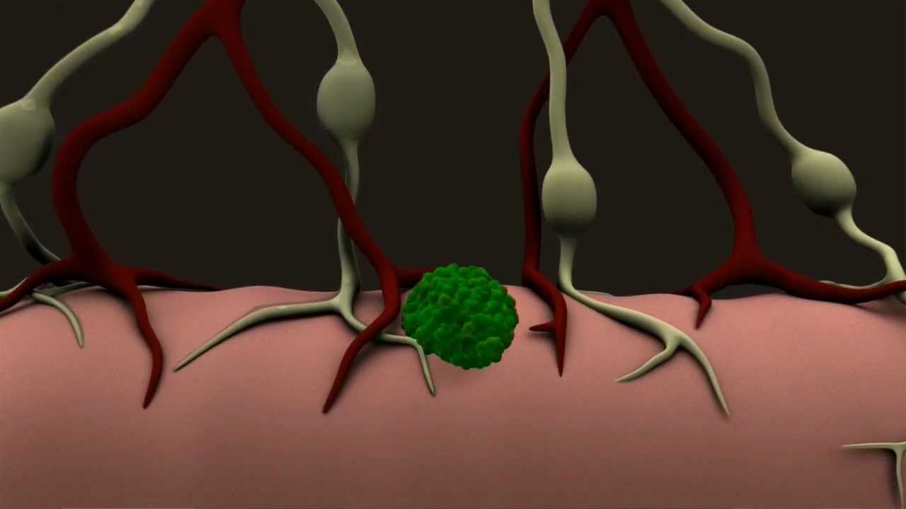 Como é que o cancro se dissemina? - YouTube