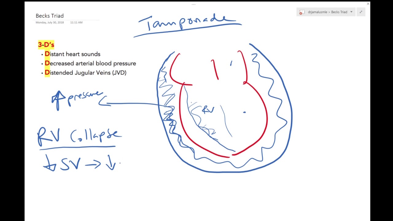 Cardiac Tamponade - Dr Jamal USMLE - YouTube