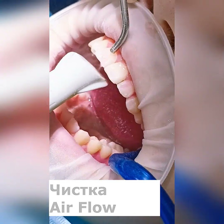 Air Flow — этап профгигиены полости рта Удаляем биопленку - YouTube