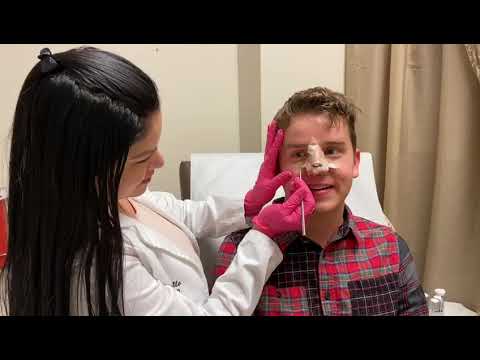 Splint Removal after Designer Rhinoplasty - YouTube