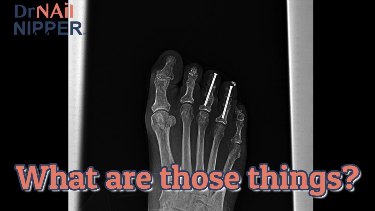 What are toe screws? Take a look with Dr Nail Nipper [Callus Tuesday ...