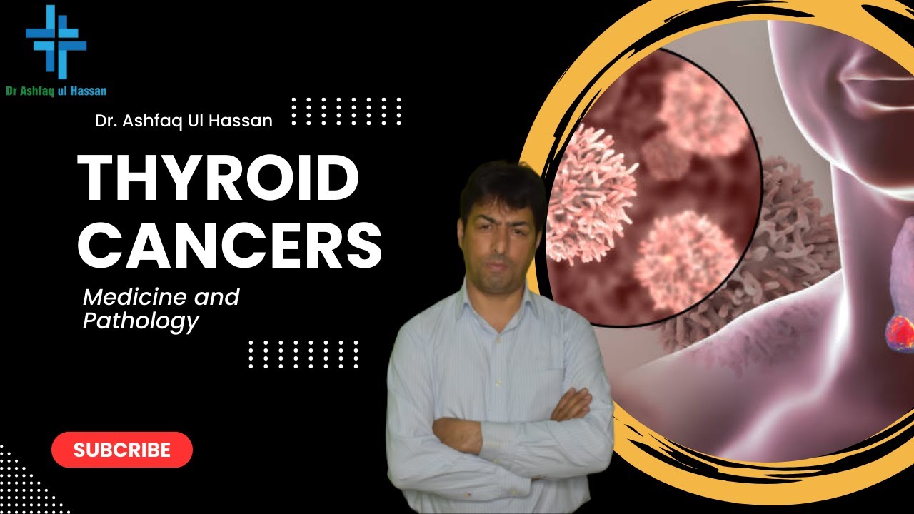 Thyroid Cancers :High Yield Points for NEETPG, USMLE, MRCP, Oncology ...