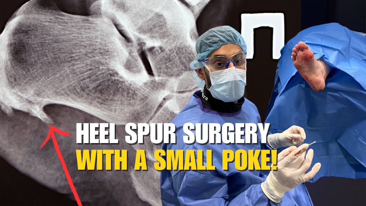 Heel Spur Surgery With a Small Poke! Part 2 - YouTube