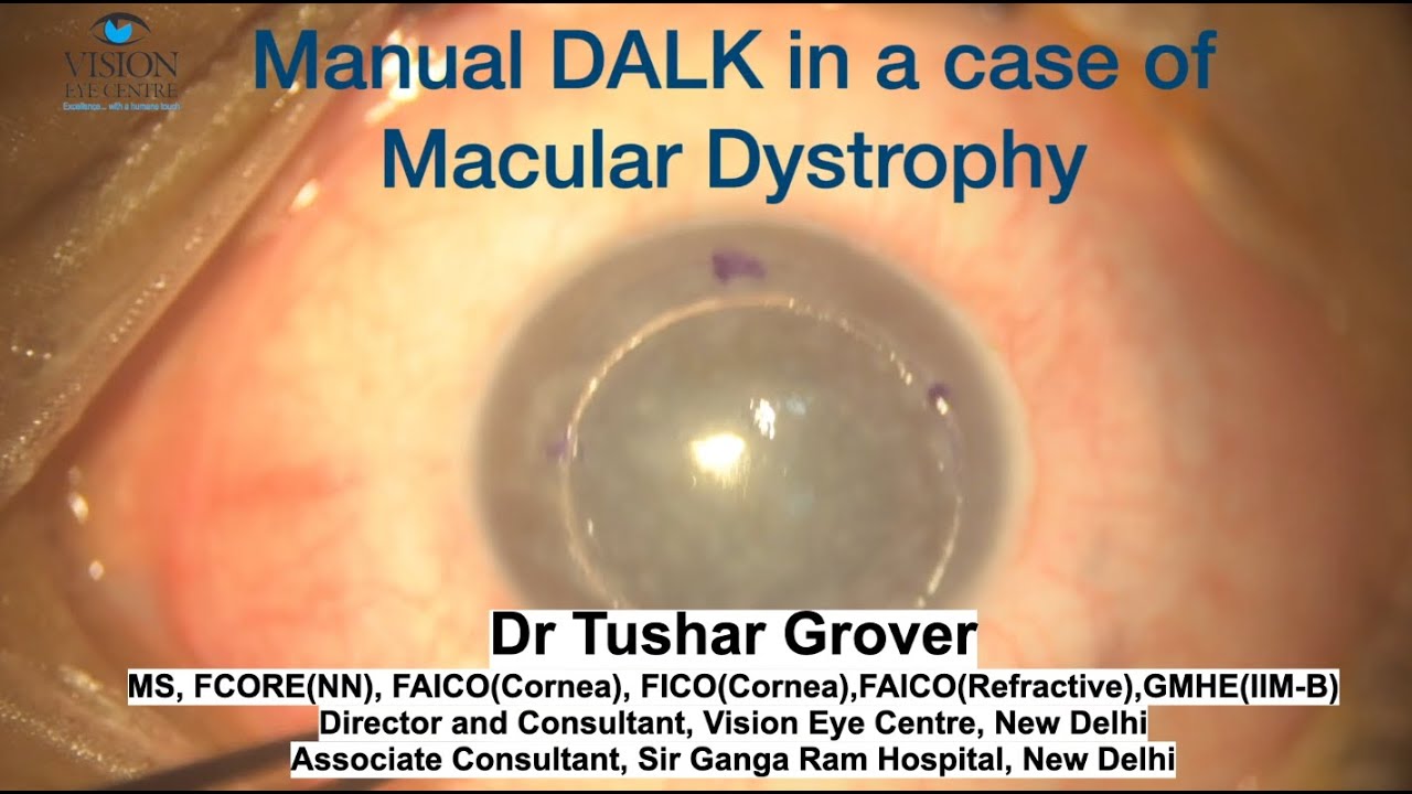 Manual Deep Anterior Lamellar Keratoplasty or DALK in a case of Macular ...