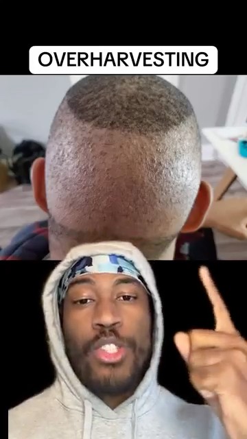 The Truth About A Hair Transplants Botching - YouTube