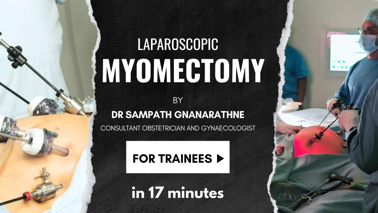Laparoscopic Myomectomy in 17 Mins | Safe Fibroid Removal by Dr ...
