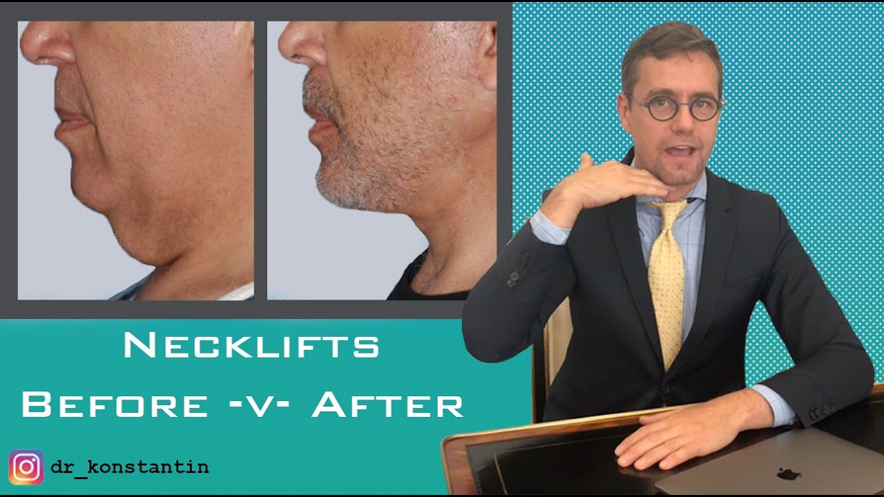 Neck Lift Transformation: Before & After - YouTube