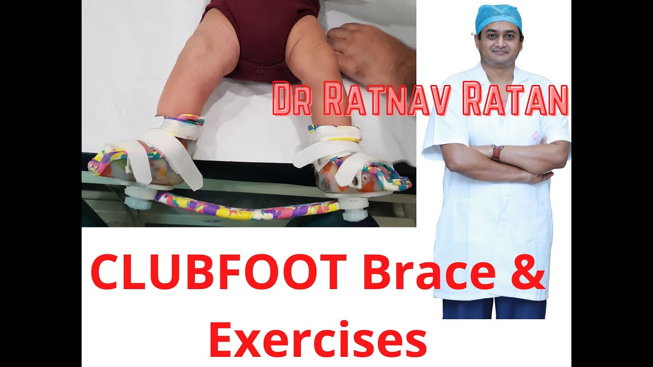 𝐁𝐫𝐚𝐜𝐢𝐧𝐠 𝐚𝐧𝐝 𝐞𝐱𝐞𝐫𝐜𝐢𝐬𝐞𝐬 𝐟𝐨𝐫 𝐂𝐥𝐮𝐛𝐟𝐨𝐨𝐭 क्लब्फूट के जूते व निर्धरित व्यायाम ...