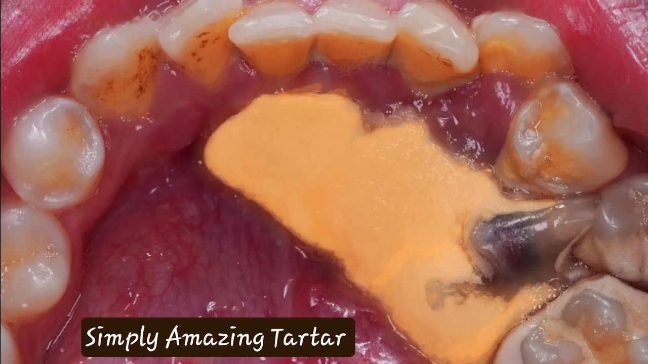 Tartar/ Calculus Removal Back of teeth #dentist #teethcleaning #plaque ...