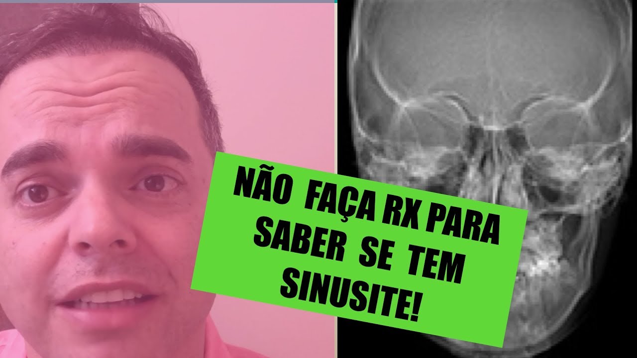 Não Faça RX para Sinusite!! - YouTube