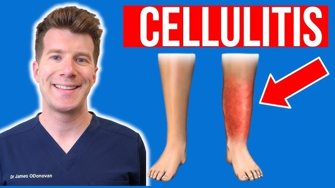 Cellulitis Causes Pictures Treatment