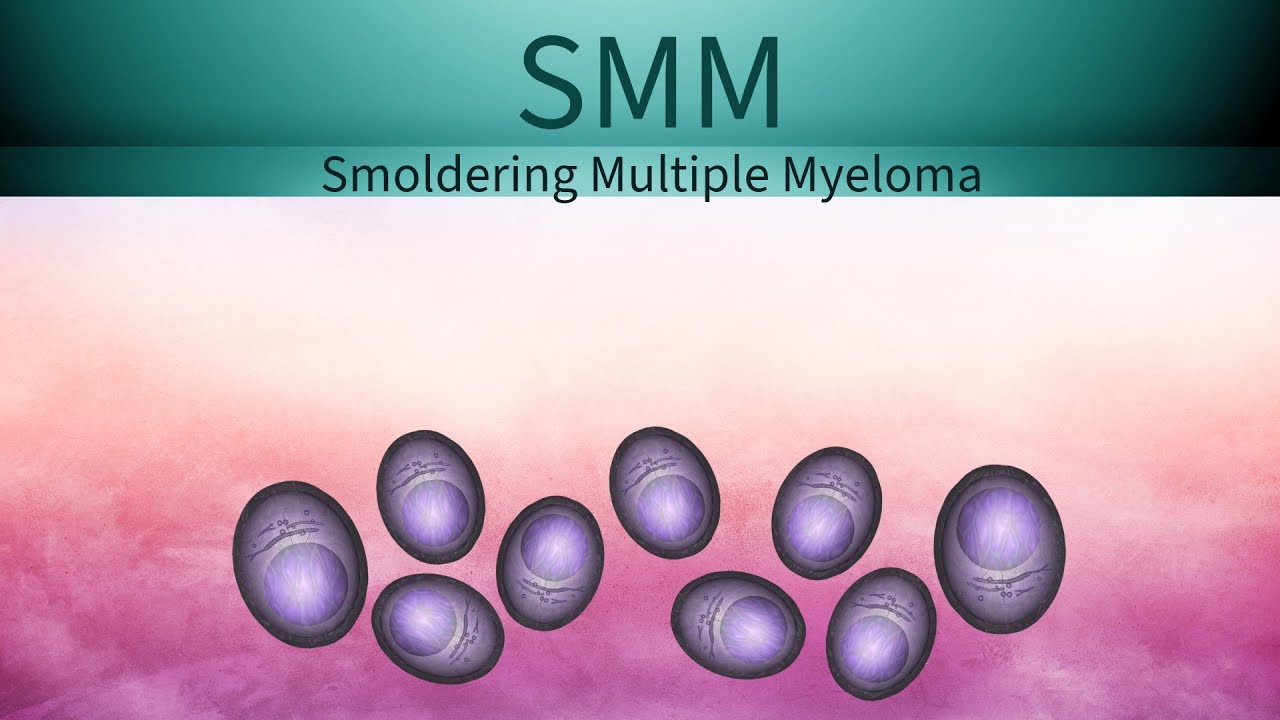Smoldering Multiple Myeloma #pathologylectures #pathology - YouTube