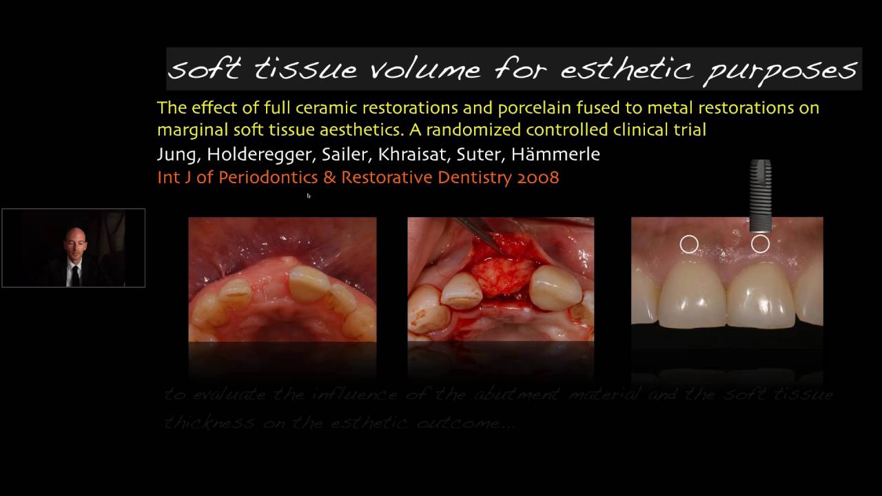 Soft Tissue Management in the Aesthetic zone - YouTube