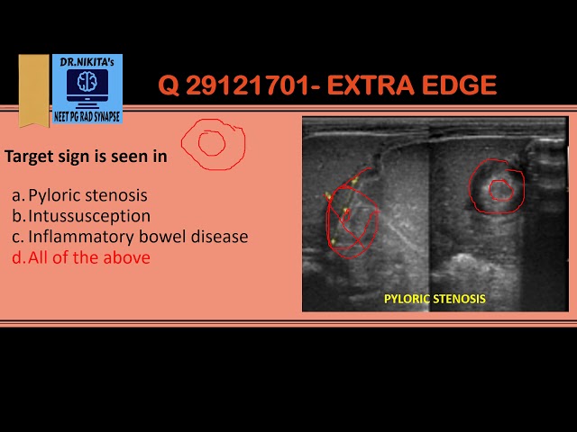 Target Sign Intussusception