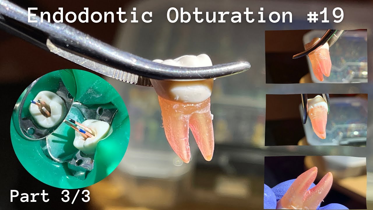 Cold Lateral Obturation #19 - Case 2 (Part 3/3) - YouTube