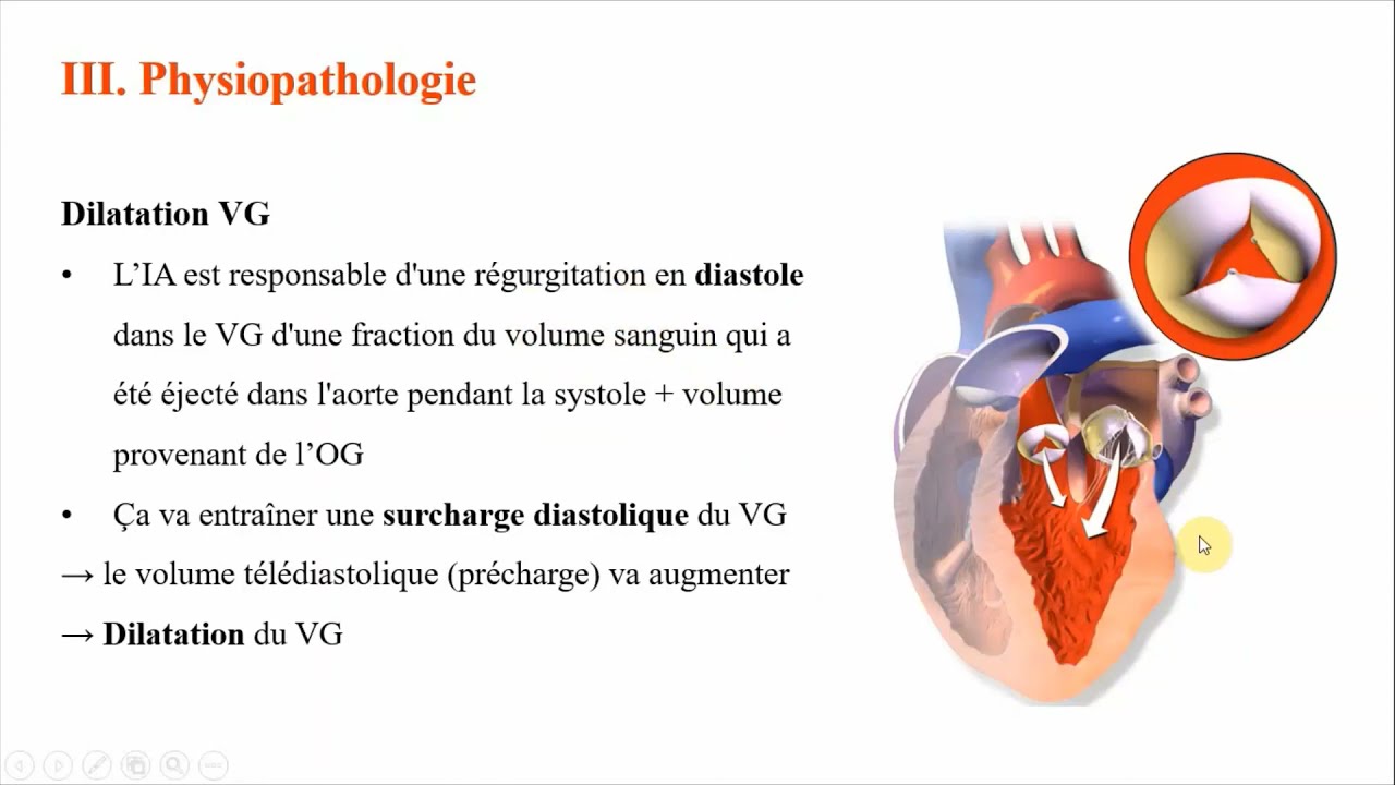 07. Insuffisance aortique (Dr M.S.Lounes) | #Cardio - YouTube