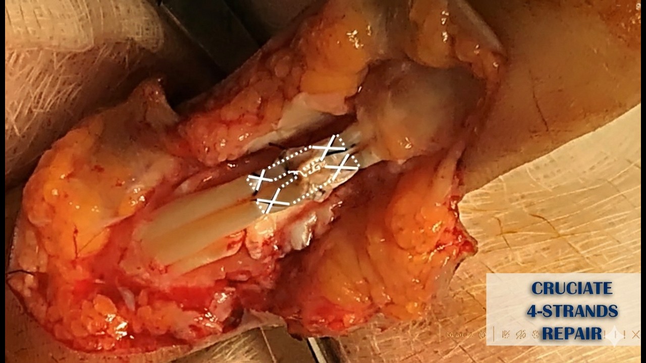 Cruciate 4-Strands Flexor Tendon Repair: Live Surgical Footage. - YouTube
