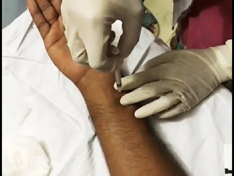 Arterial blood gas analysis procedure || ABG কীভা‌বে করা হয়? - YouTube