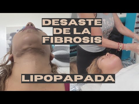 Como eliminar la fibrosis despues de LIPOPAPADA (vida sana)gaviota ...