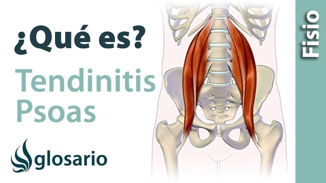 TENDINITIS DEL PSOAS | ¿Qué es? - YouTube