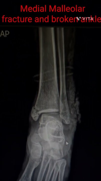 ️love X Ray Medial Malleolar Fracture And Broken Ankle Xray Ankle Joint Ap Motivation Youtube