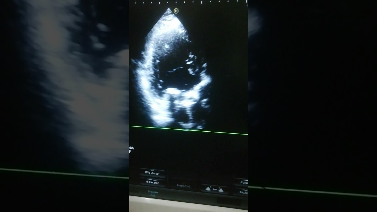 post MVR. Prosthesis mitral valve. - YouTube