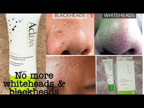 Aclean cream review || No More whiteheads And Blackheads - YouTube