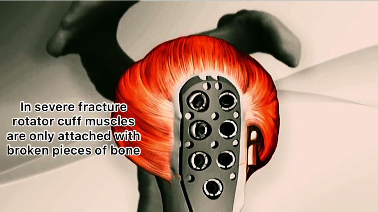 Proximal humerus Fracture Repair - YouTube