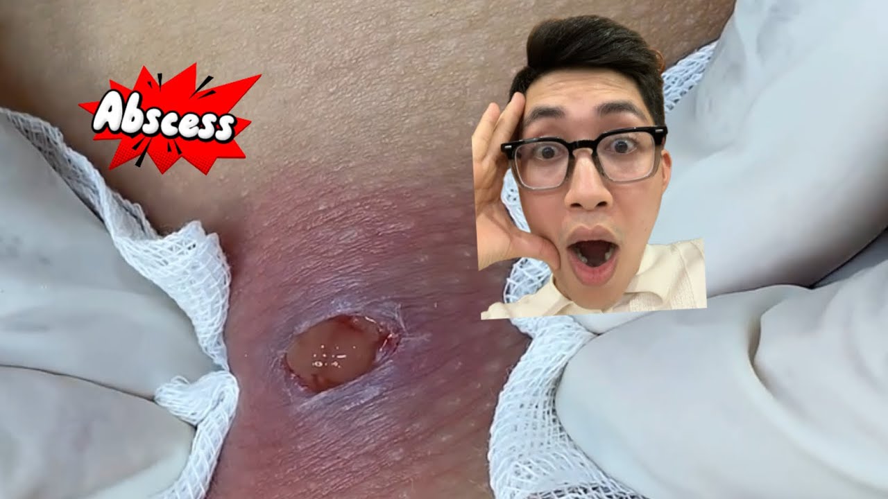 INSANE Buttock Abscess Drainage – You Won’t Believe What Came Out ...