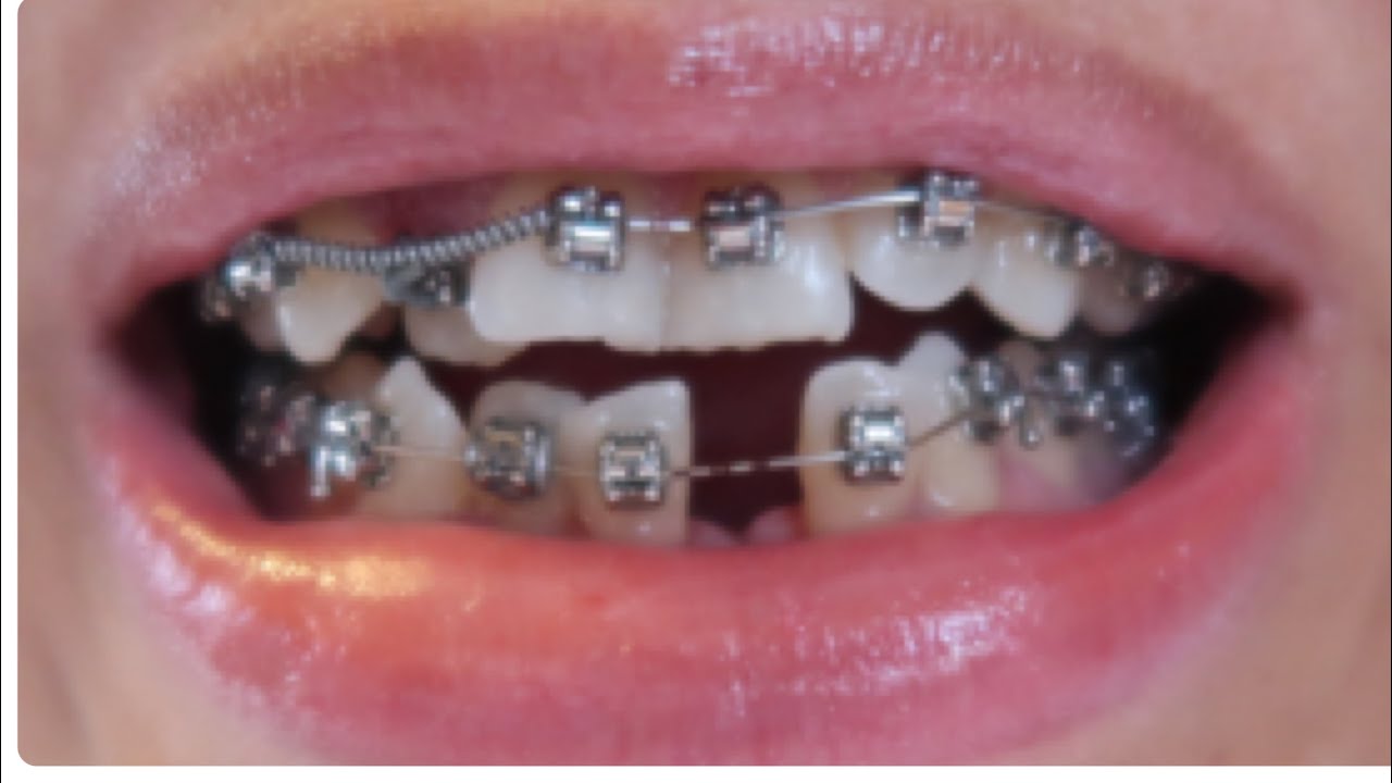 Frenillos ortodoncia #brackets #sonrisa #smile #ligas - YouTube