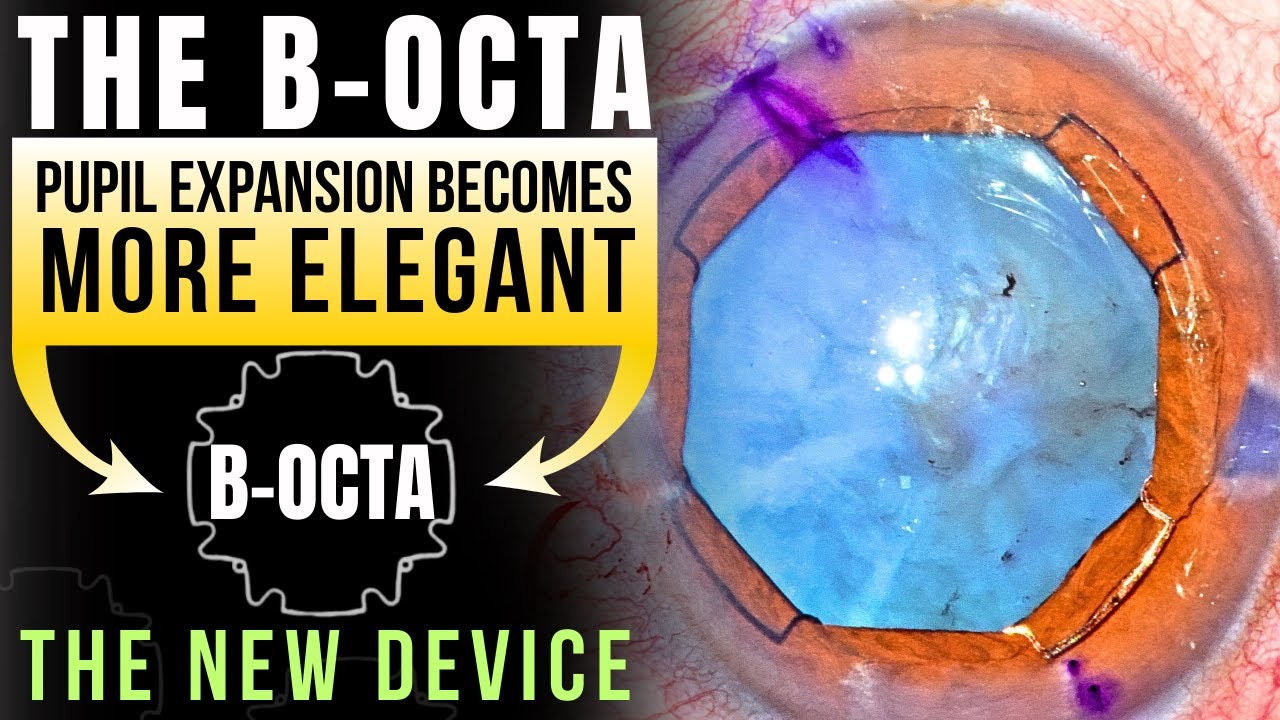 The "B-OCTA" pupil expansion becomes more elegant "Bocta the new device ...