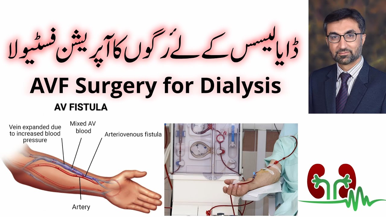 AVF (Arteriovenous Fistula) for Dialysis. Procedure and Details by Dr ...