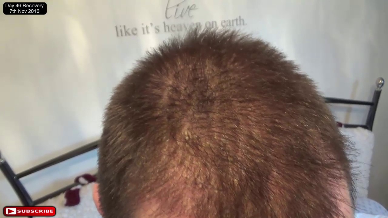 FUE Hair Transplant: Day 46 Post Op Recovery - YouTube