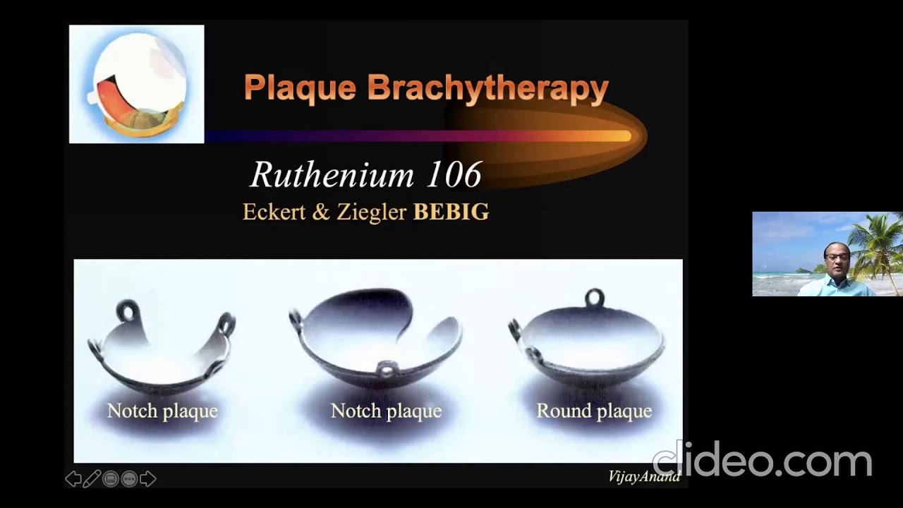 Plaque Brachytherapy in Ophthalmic Tumors_Dr P. Vijay Anand Reddy - YouTube