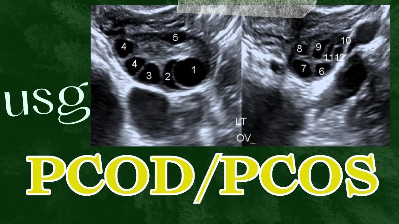 PCOD/PCOS USG FINDING'S & COMPLAINTS - YouTube