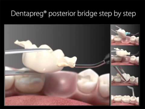 Dentapreg Posterior Bridge Training - YouTube