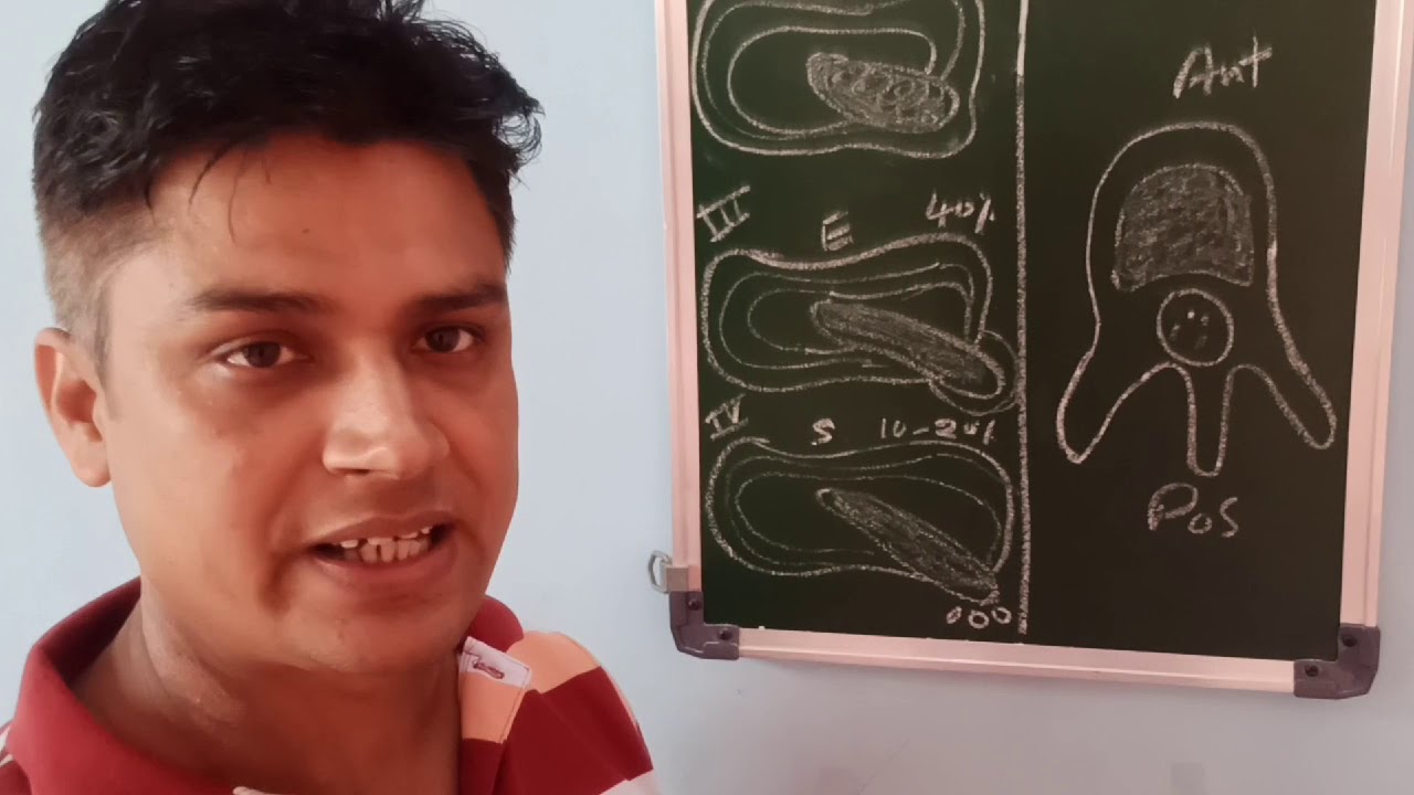 PIVD L4-L5, (Grades) By Dr. Dev (Physiotherapist) - YouTube