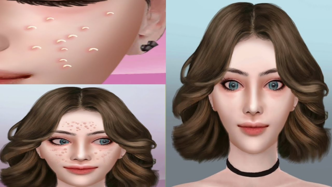 ASMR | Acne Removal Whitehead extraction/ Pimple popping animation ...