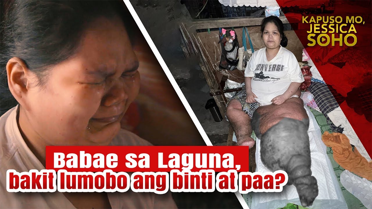 Babae sa Laguna, lumobo ang kaliwang binti at paa | Kapuso Mo, Jessica ...